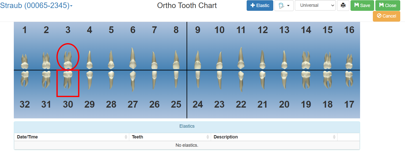 Using the Uncover and Evaluation Options from the Ortho Tooth Chart in ...